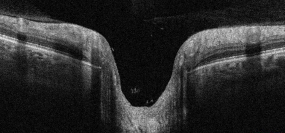 OCT in glaucoma | E-learning | Viewpoint