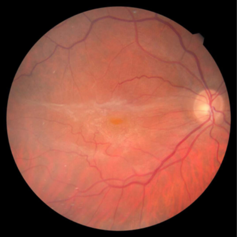 Corneal thickness measurement: Pachymetry, a practitioner’s guide