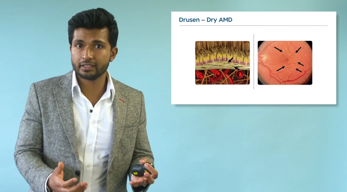How to evaluate AMD patients in your busy optom clinic | Viewpoint