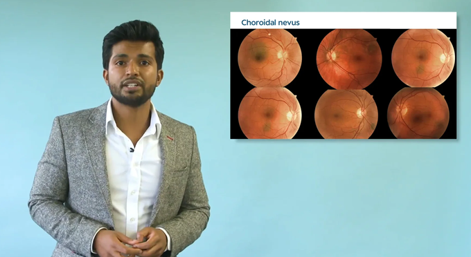 How to evaluate choroidal nevus in your optom clinic | Viewpoint