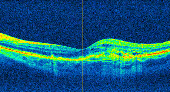 Clinical Saloon in Aarhus: Dry and wet AMD | Viewpoint