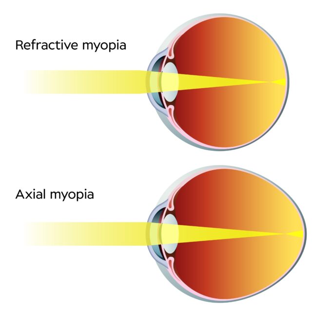 How to get started with myopia management | Viewpoint