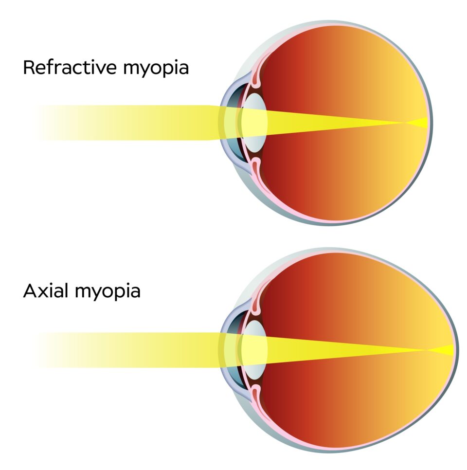 How to get started with myopia management | Viewpoint