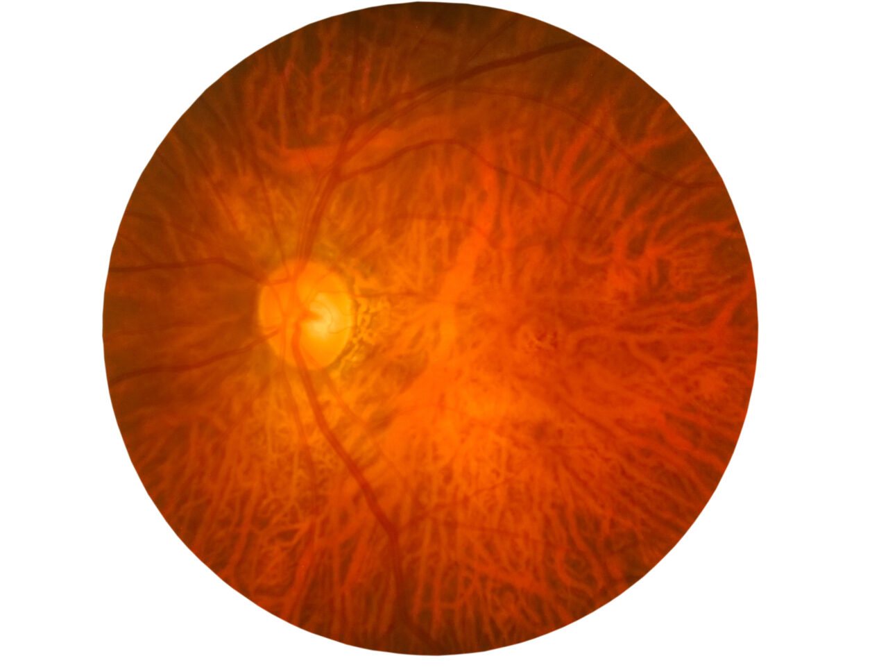 How to get started with myopia management | Viewpoint