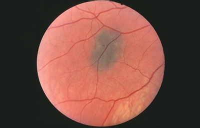 Optometry Atlas: Uvea | Viewpoint