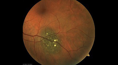 Optometry Atlas: Uvea | Viewpoint