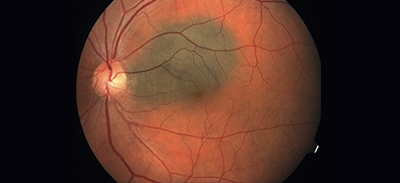 Optometry Atlas: Uvea | Viewpoint