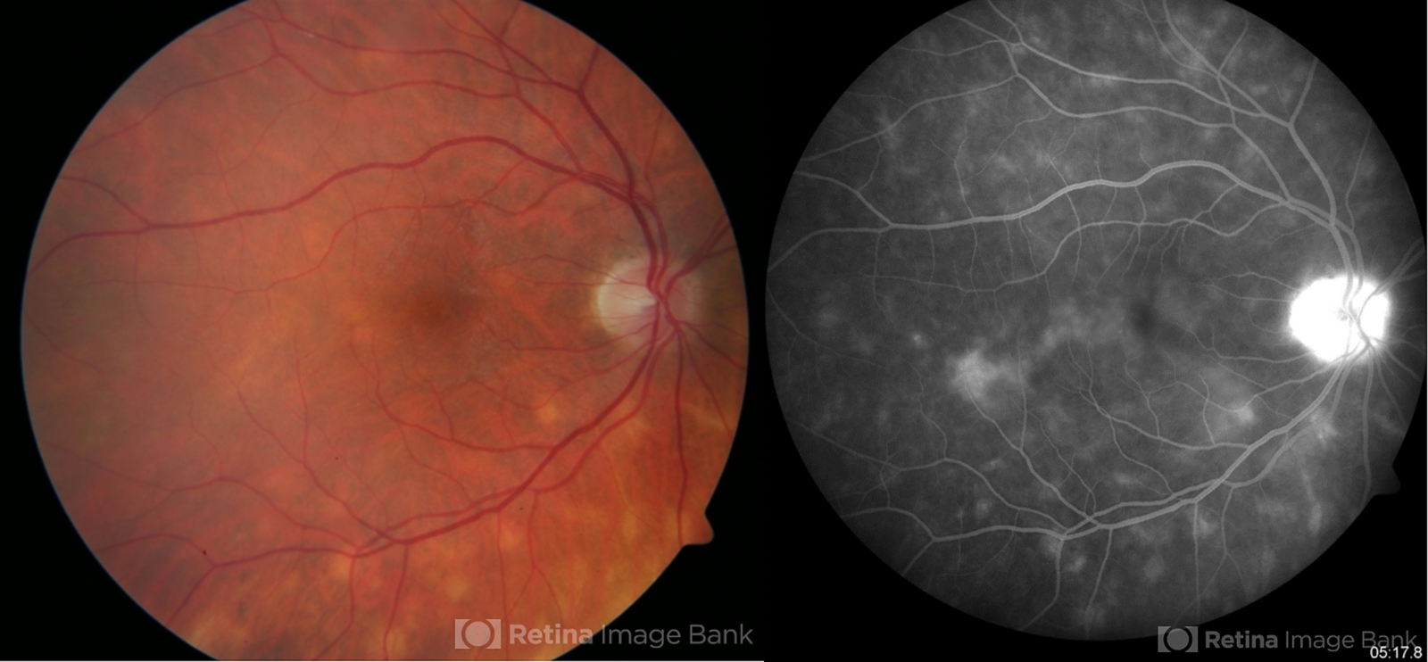Optometry Atlas: Uvea | Viewpoint