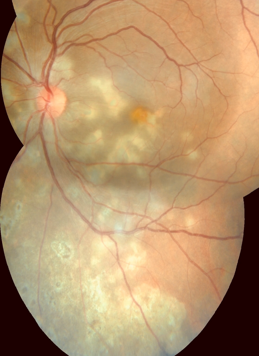 Optometry Atlas: Uvea | Viewpoint