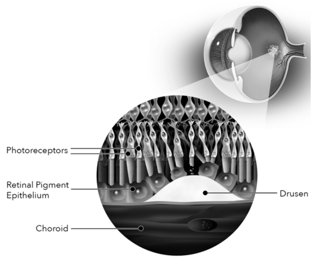 Optometry Atlas: Macular diseases | Viewpoint