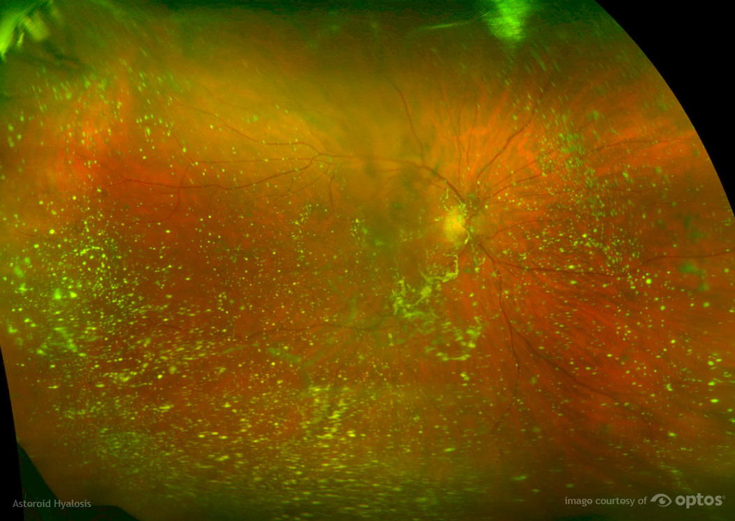 Optometry Atlas: Vitreous | Viewpoint