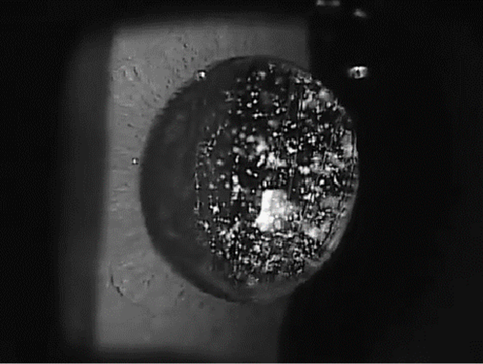 Optometry Atlas: Vitreous | Viewpoint