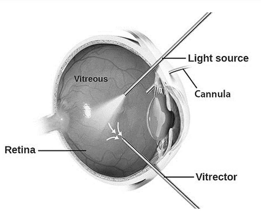 Optometry Atlas: Vitreous | Viewpoint
