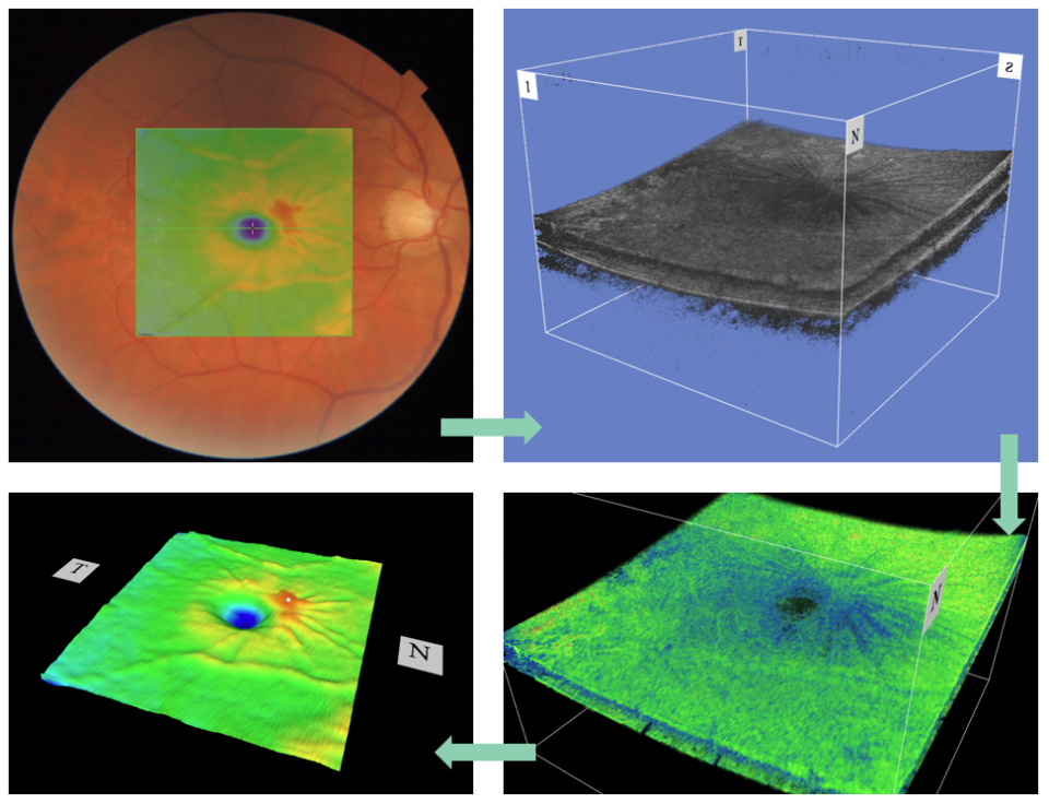 Optometry Atlas: Vitreomacular interface abnormalities | Viewpoint