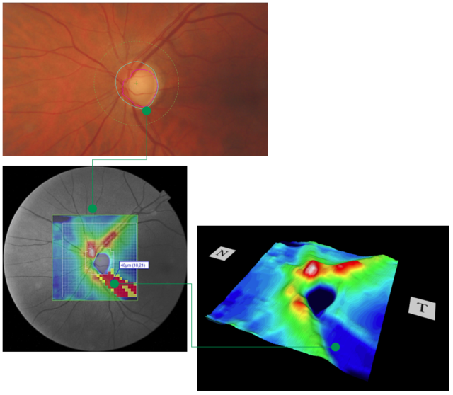 Optometry Atlas: Optic nerve conditions | Viewpoint