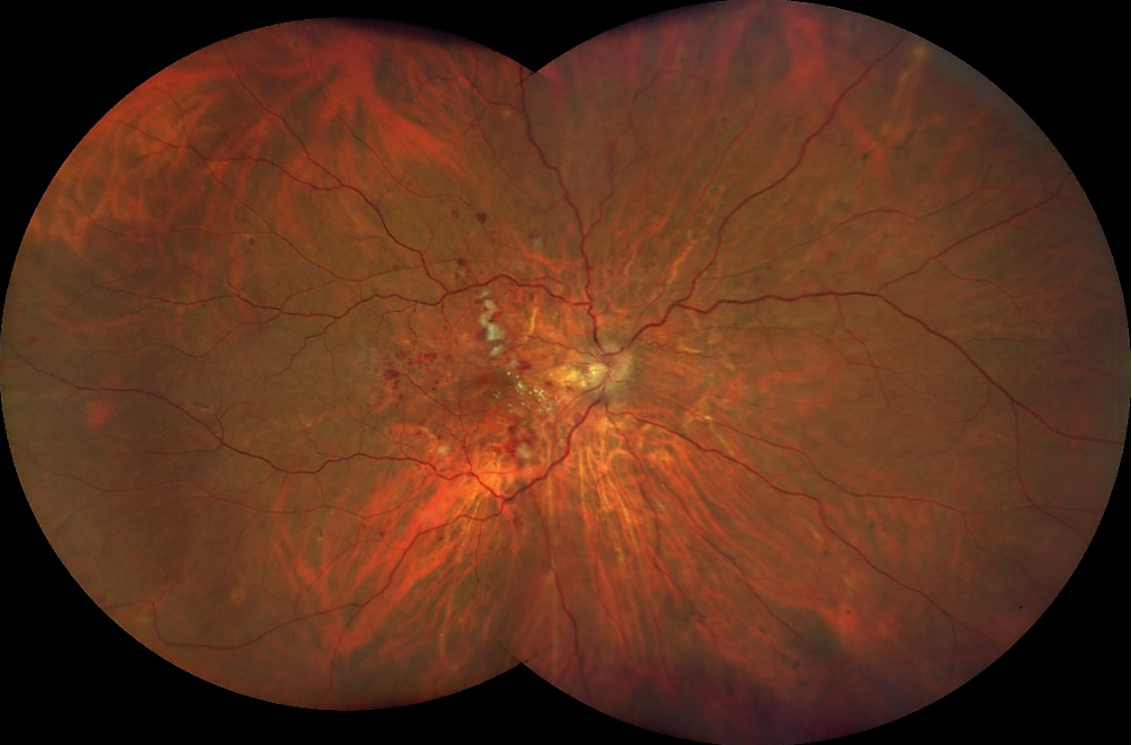 Optometry Atlas: Retinal vascular diseases | Viewpoint