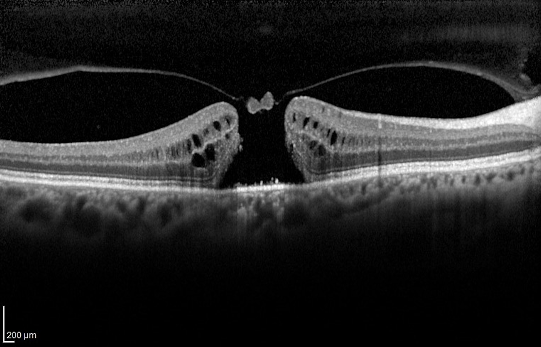 Optometry Atlas: Vitreomacular interface abnormalities | Viewpoint