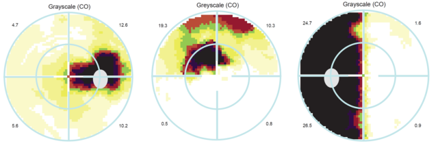 Optometry Atlas: Optic nerve conditions | Viewpoint