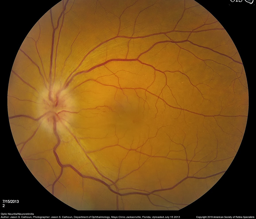Optometry Atlas: Optic nerve conditions | Viewpoint