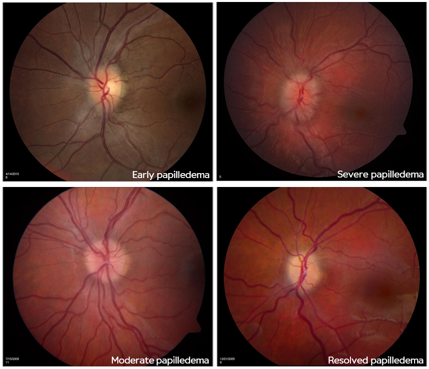 Papilledema Vs Glaucoma Papilledema Disc Swelling #CO0032 Stock