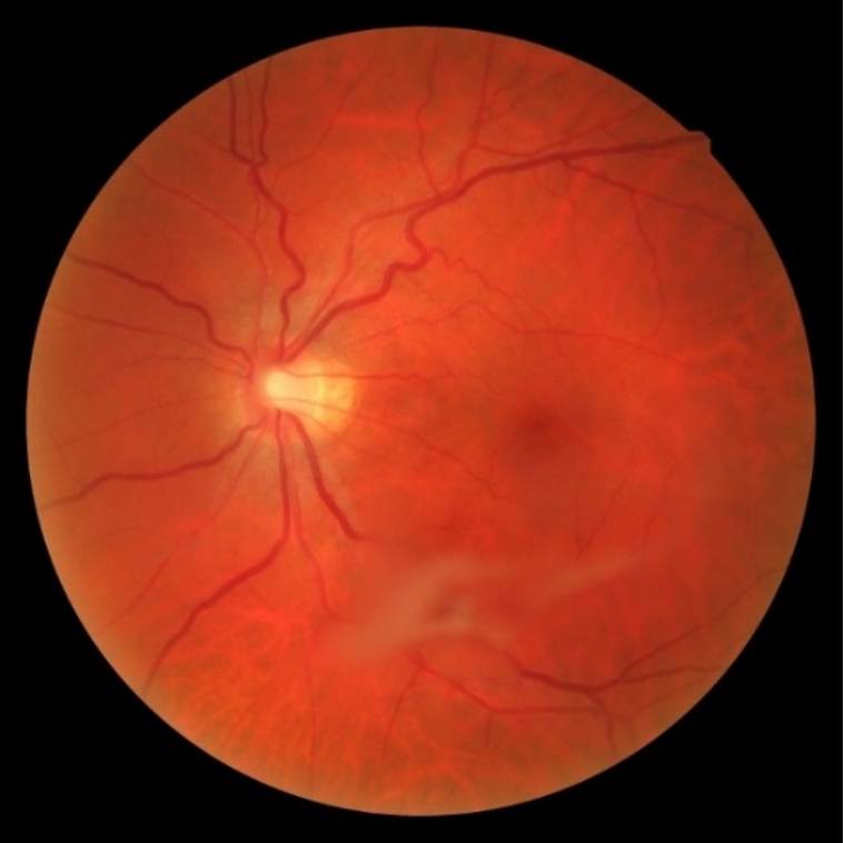 Optometry Atlas: Vitreous | Viewpoint