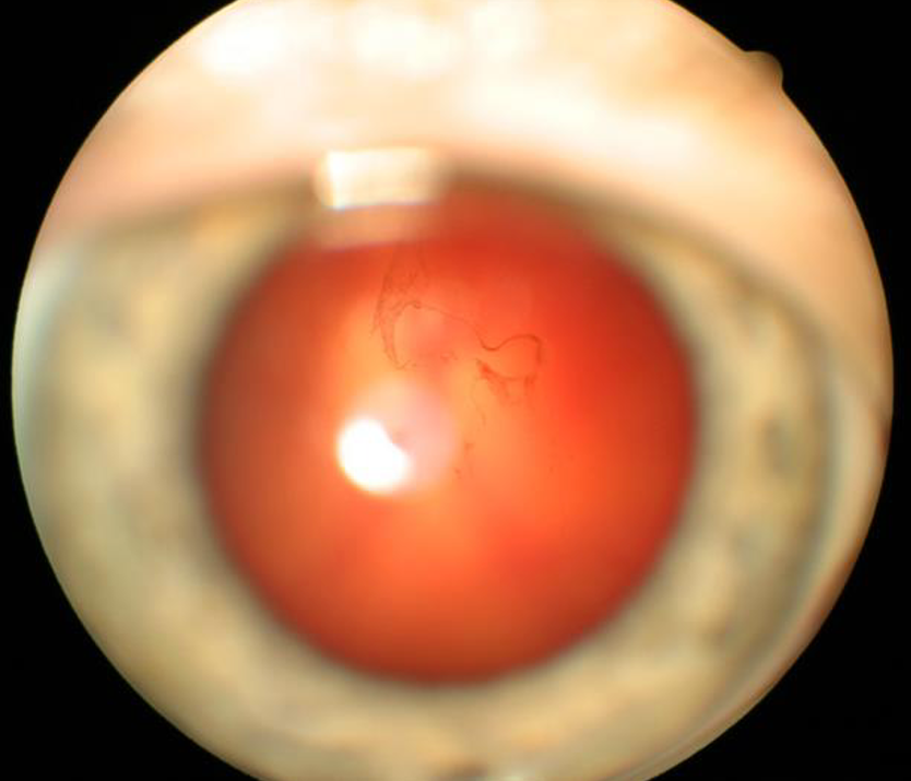 Optometry Atlas: Vitreous | Viewpoint
