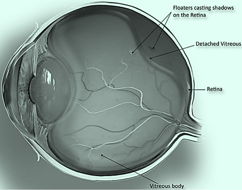 Optometry Atlas: Vitreous | Viewpoint