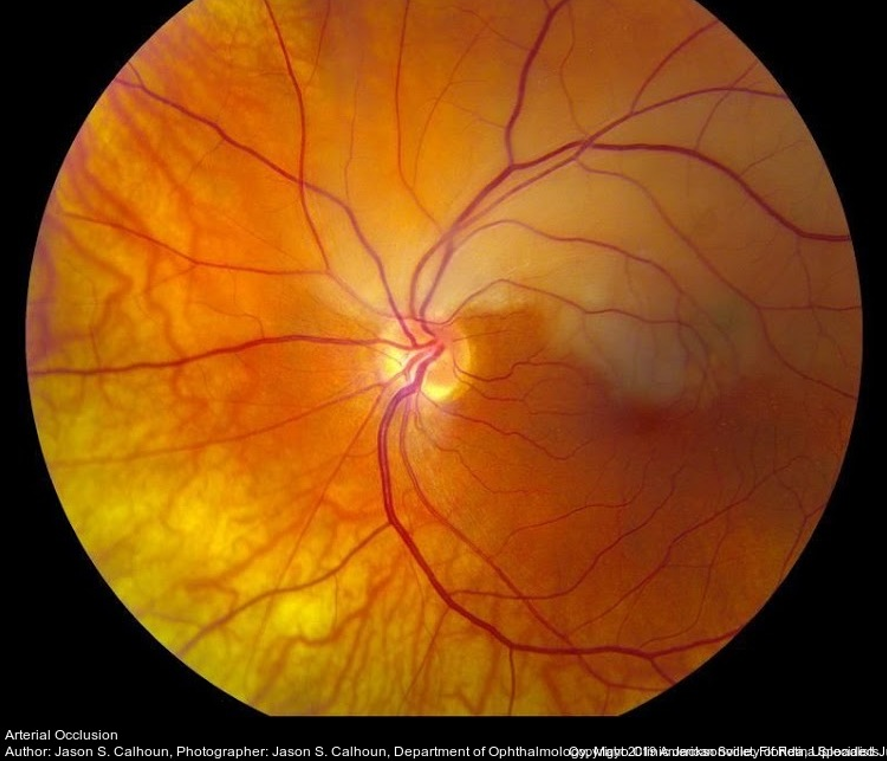 Optometry Atlas: Retinal vascular diseases | Viewpoint