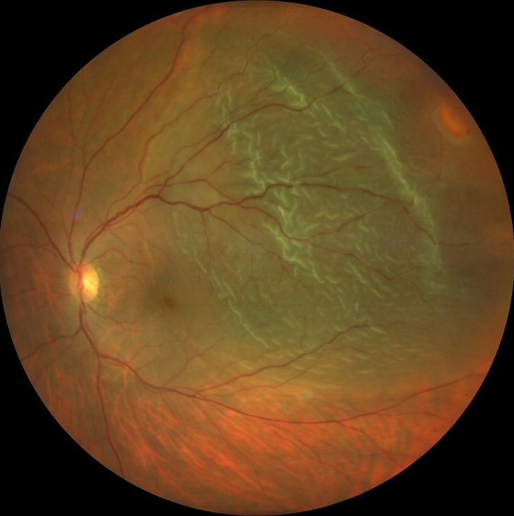Optometry Atlas: Vitreoretinal interface abnormalities | Viewpoint