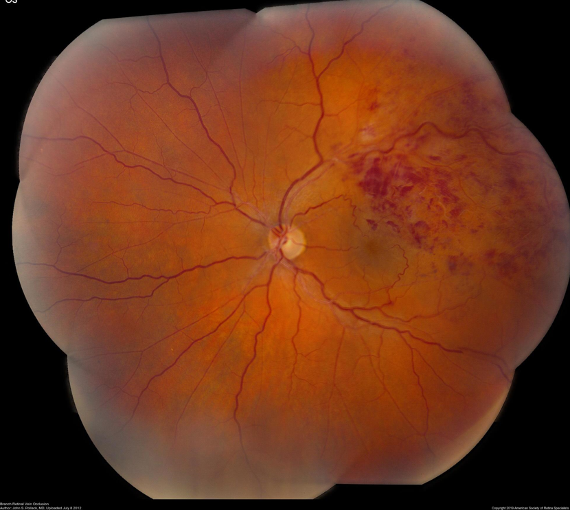 Optometry Atlas: Retinal vascular diseases | Viewpoint