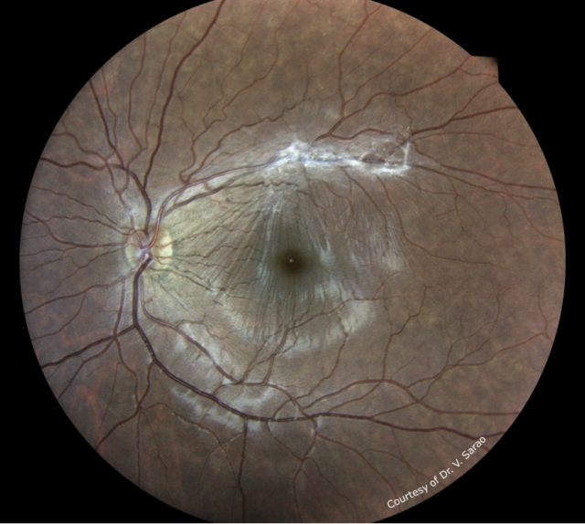 Optometry Atlas: Vitreomacular interface abnormalities | Viewpoint