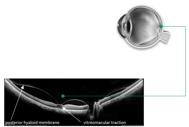 Optometry Atlas: Vitreomacular interface abnormalities | Viewpoint