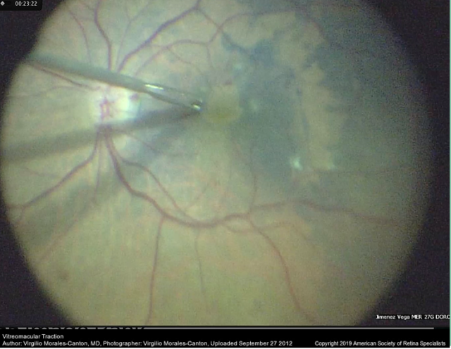 Optometry Atlas: Vitreomacular interface abnormalities | Viewpoint