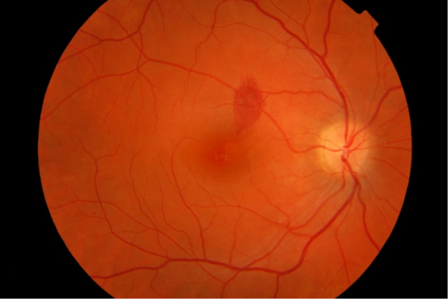 Optometry Atlas: Vitreous | Viewpoint