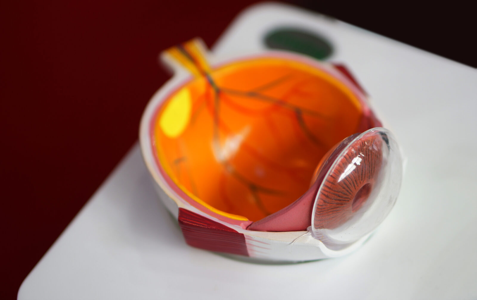 Optometry Atlas: Vitreous | Viewpoint