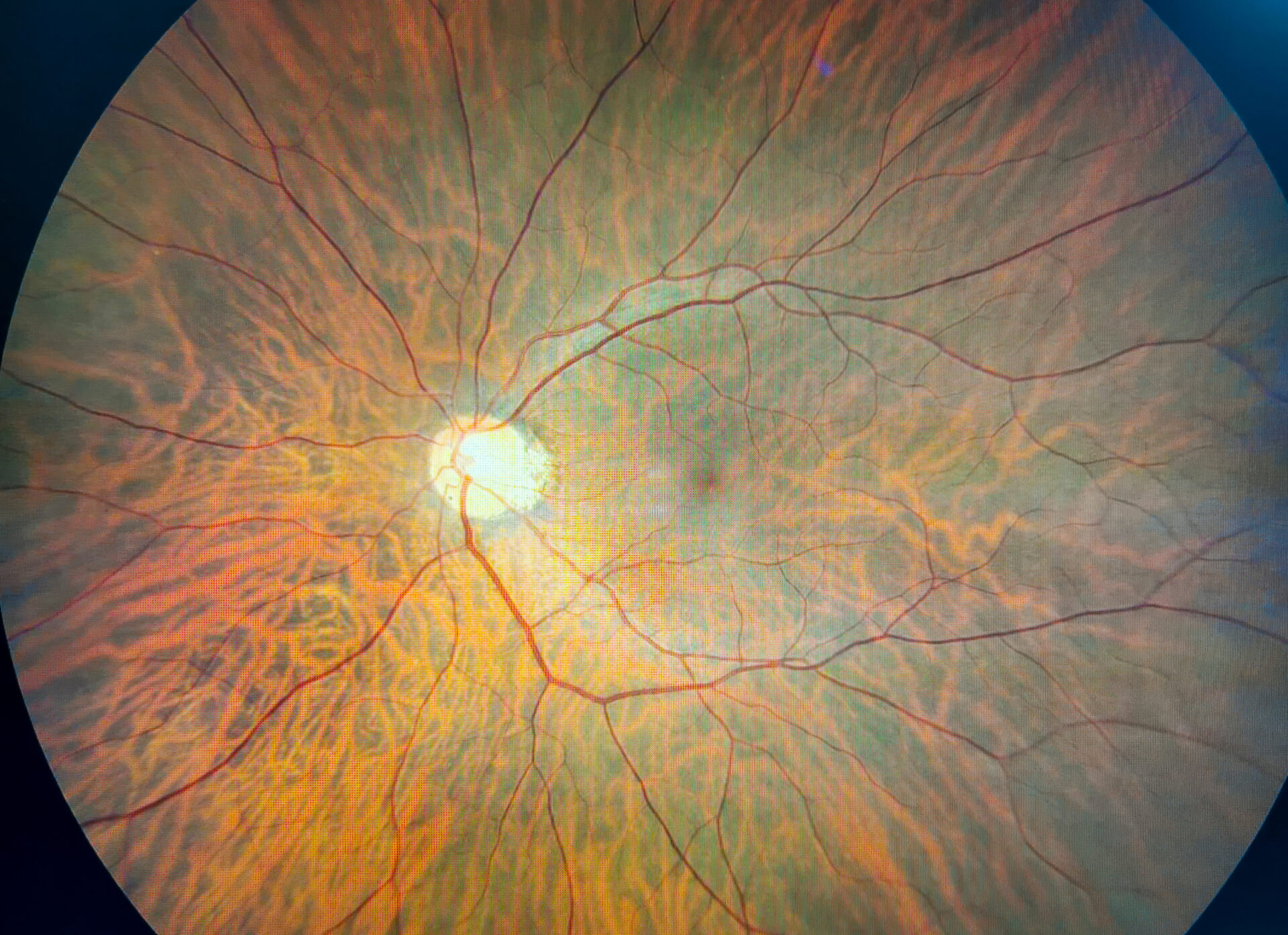 Optometry Atlas: Optic nerve conditions | Viewpoint