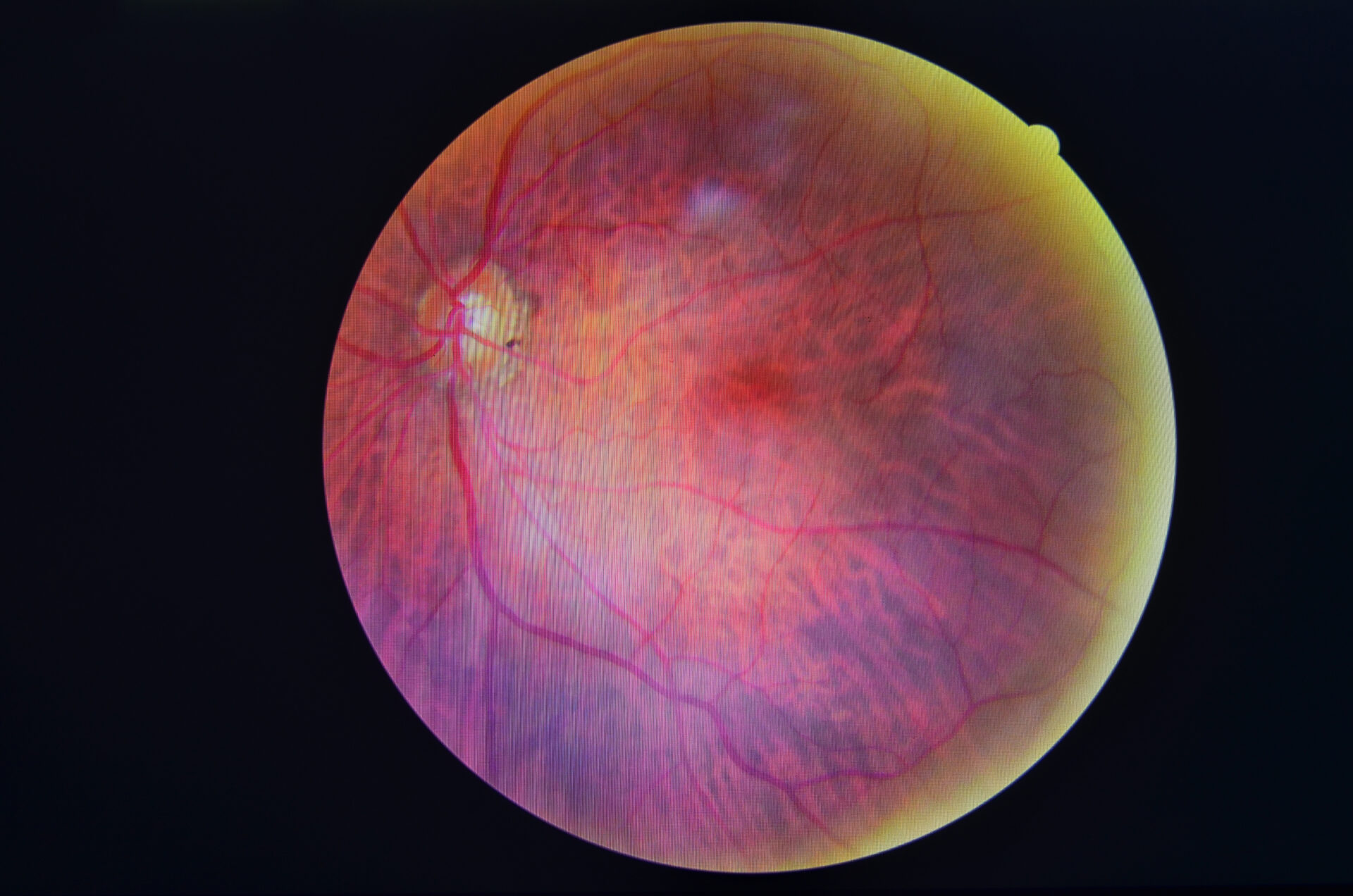 Optometry Atlas: Retinal vascular diseases | Viewpoint