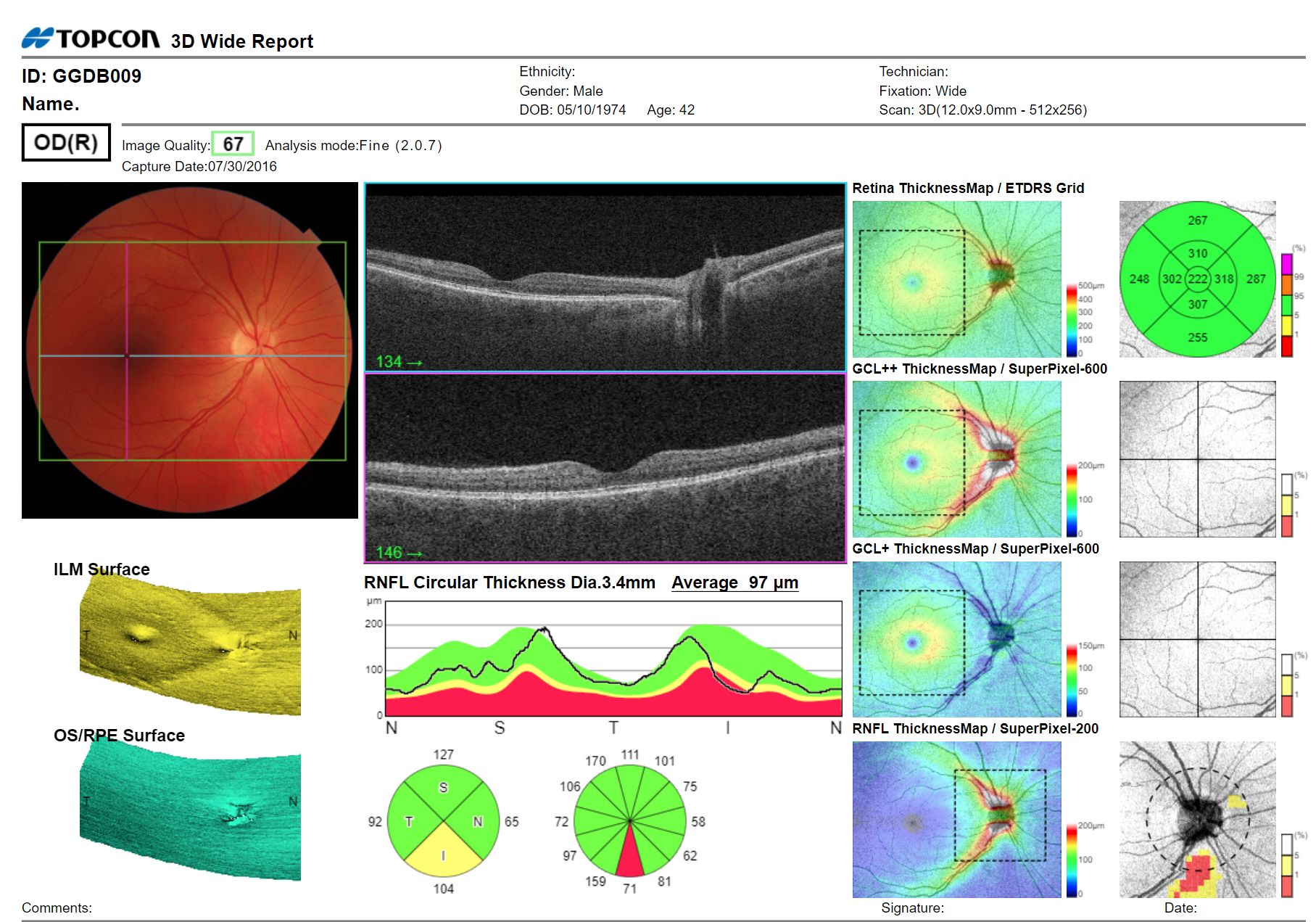 How to optimise glaucoma detection in practice | Viewpoint