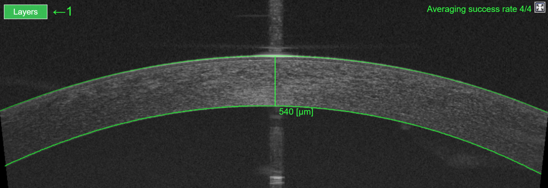 How to optimise glaucoma detection in practice | Viewpoint