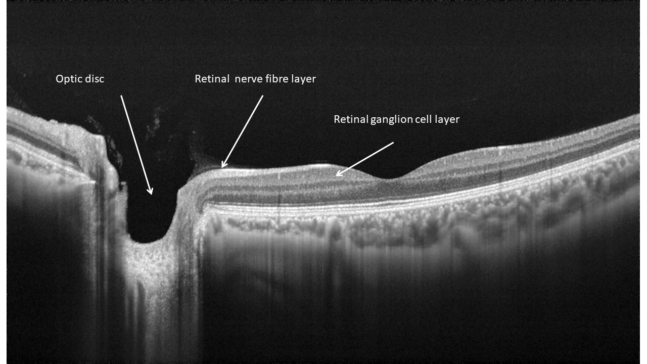 How to optimise glaucoma detection in practice | Viewpoint