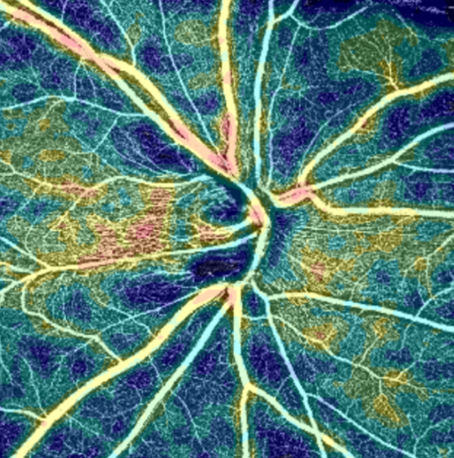 How to optimise glaucoma detection in practice | Viewpoint