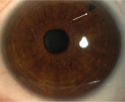 Primary and secondary angle-closure glaucoma | Viewpoint