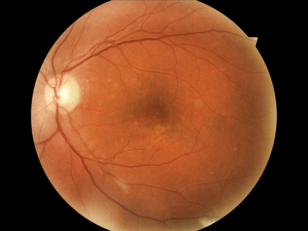 Age Related Macular Degeneration Viewpoint