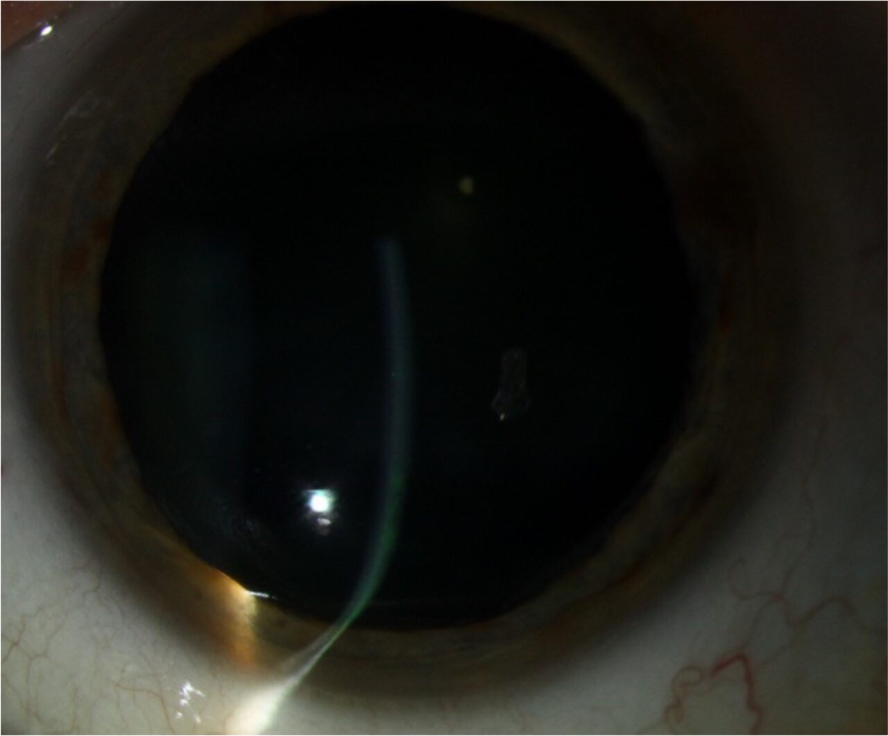 Keratoconus and corneal ectasia | Viewpoint
