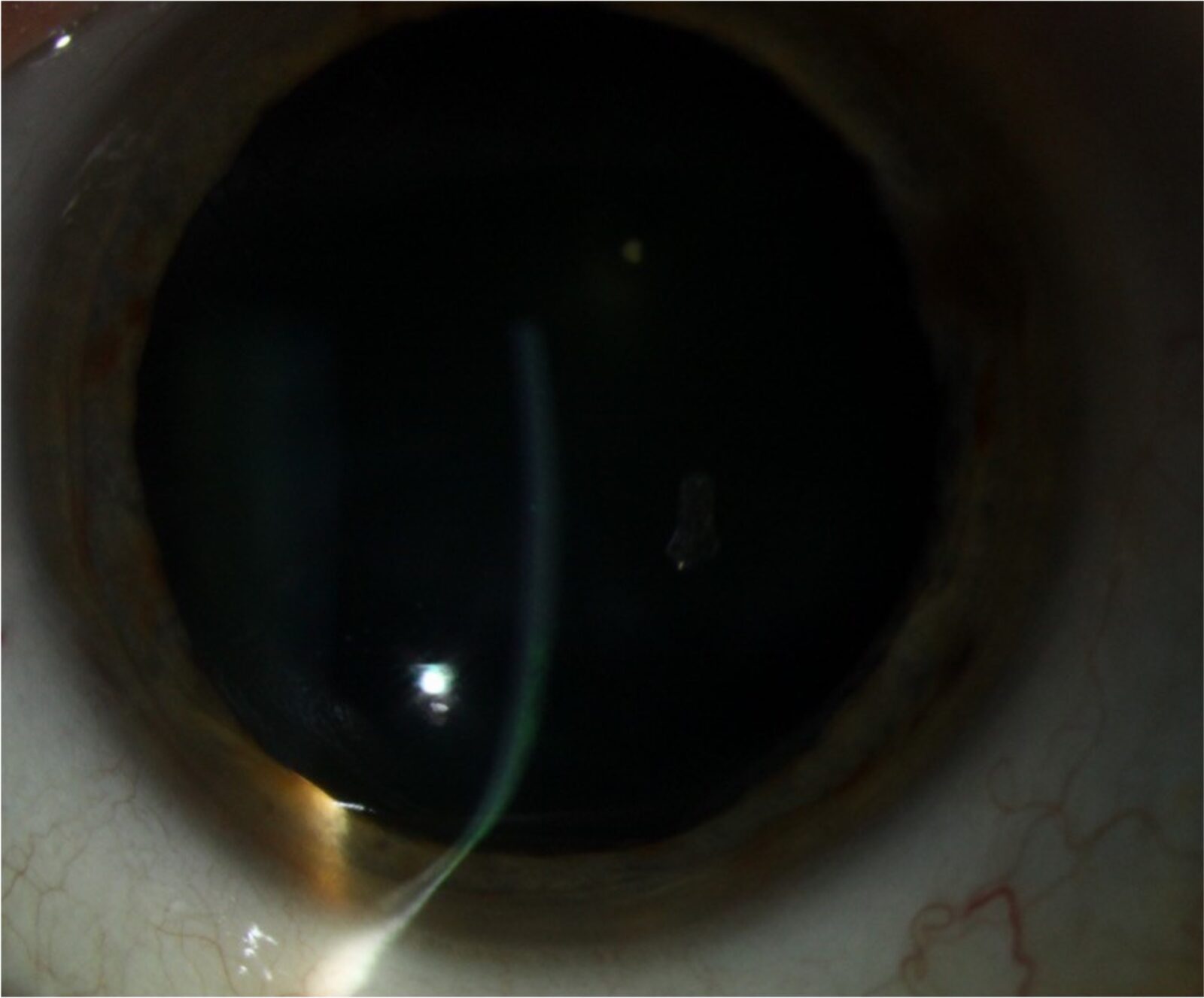 Keratoconus and corneal ectasia | Viewpoint