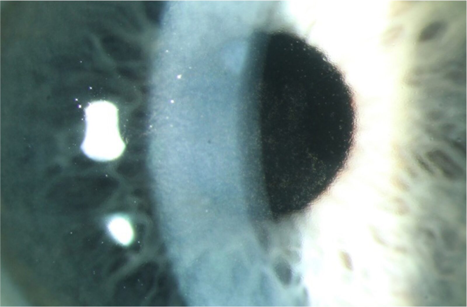 Bullous keratopathy | Viewpoint