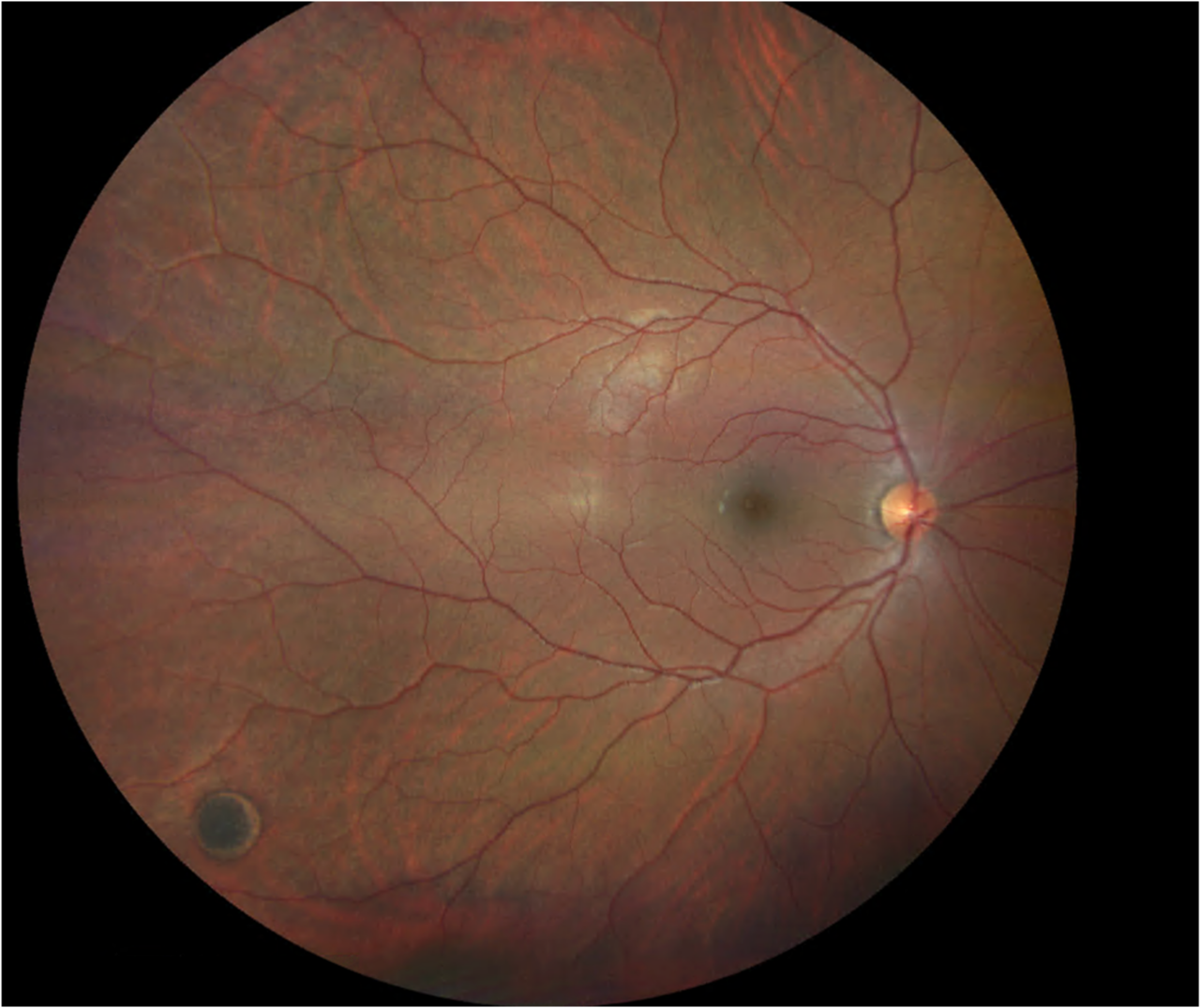 Benign chorioretinal lesions | Viewpoint