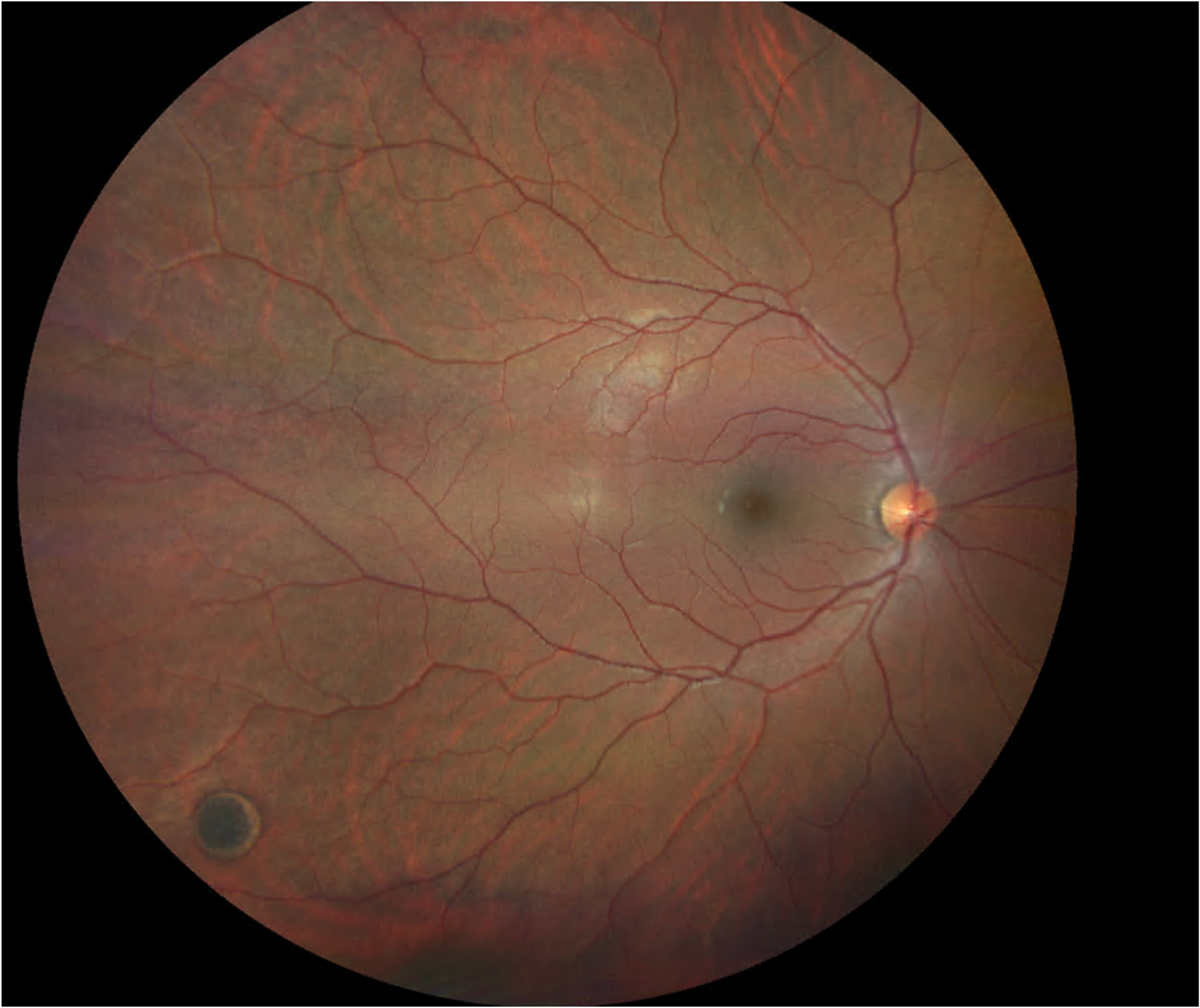 Benign chorioretinal lesions | Viewpoint
