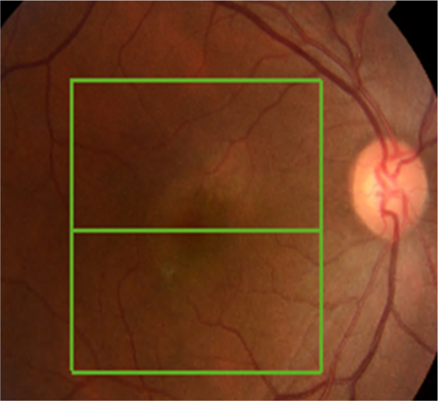 Central serous retinopathy and pachychoroidal conditions | Viewpoint