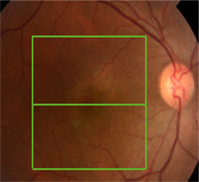 Central serous retinopathy and pachychoroidal conditions | Viewpoint